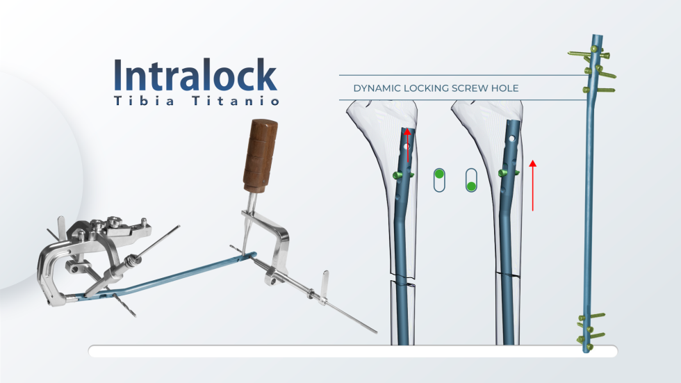 INTRALOCK Clavo Intramedular para Tibia - Traufix México