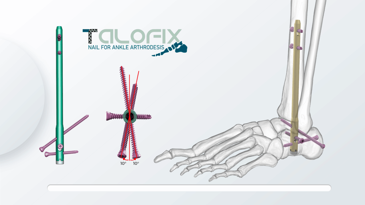 TALOFIX Clavo Intramedular para Artrodesis de Tobillo - Traufix México